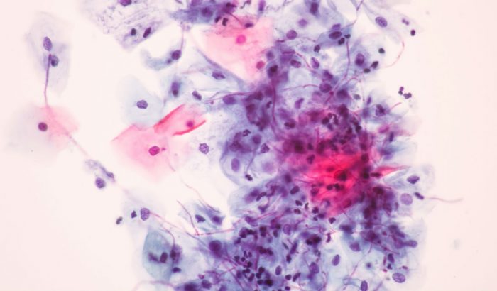 Što je Candida i kako je se riješiti – JGL Obitelj